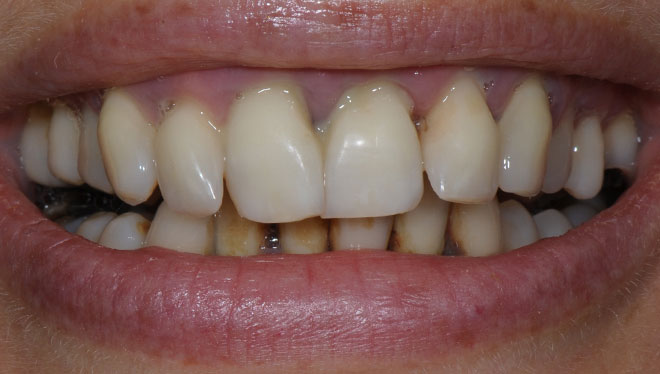 Implants : Dr Andrew Dillon